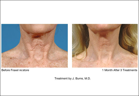 Fraxel - Chappaqua, NY Dermatologist
