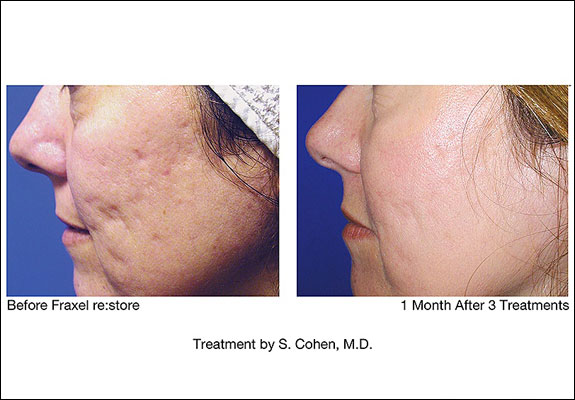 Fraxel - Chappaqua, NY Dermatologist